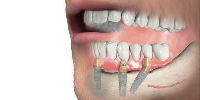 Dr Manolakis: bredent Implant Systems