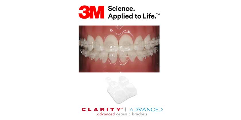 Clarity ADVANCED Ceramic Brackets