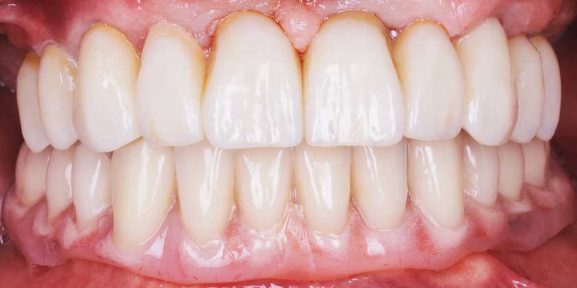 FP1 Full-arch Implant Restoration