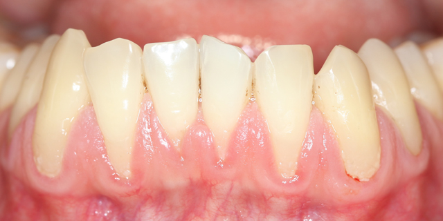 Jacob Watwood: Gingival Recession