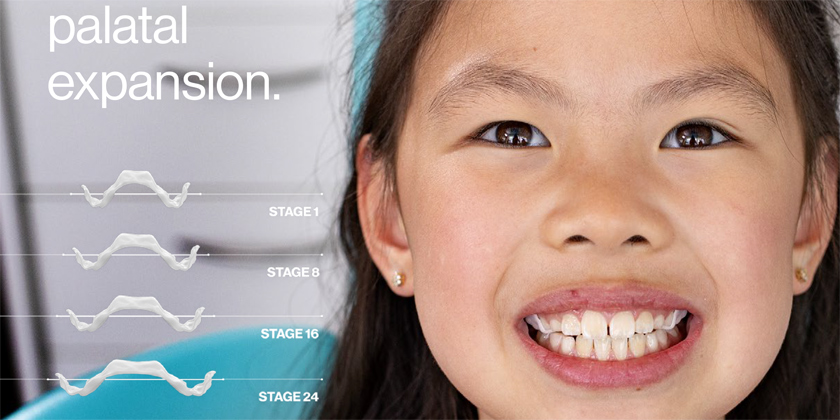 Invisalign Palatal Expander