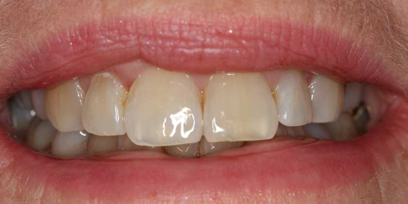 Dr Patrick Puckett: Inman Aligner Case Study