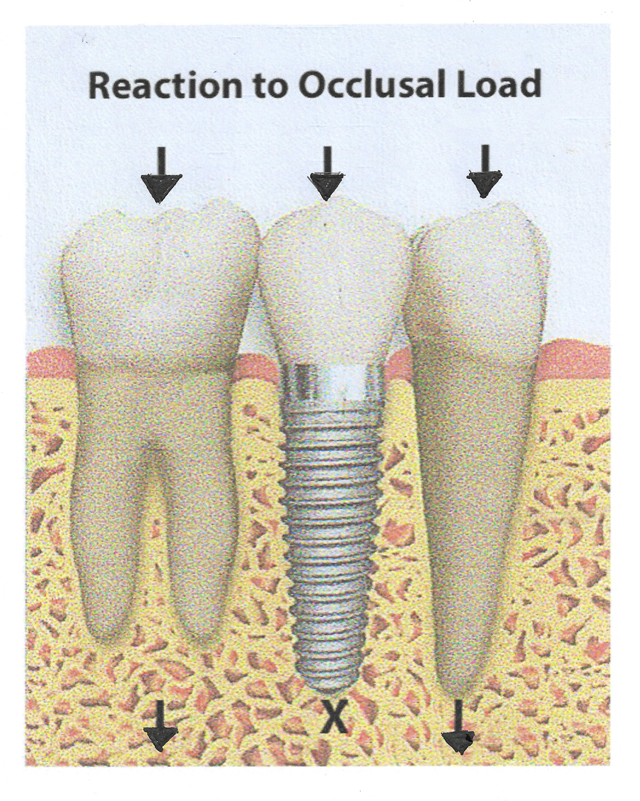 Occlusion and Implants