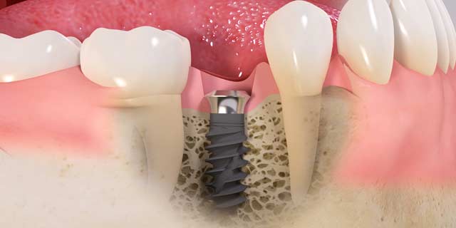 TLX Implant System from the Straumann Group