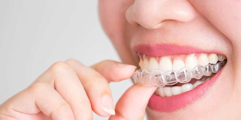 Invisalign Smile Architect