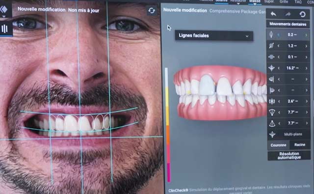 Invisalign Smile Architect Launch