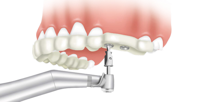 Adin Guided Implant Surgery