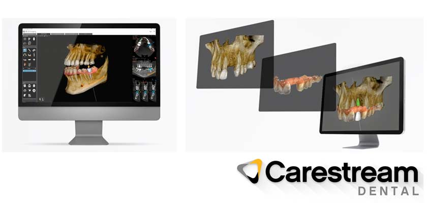 PDIP from Carestream Dental