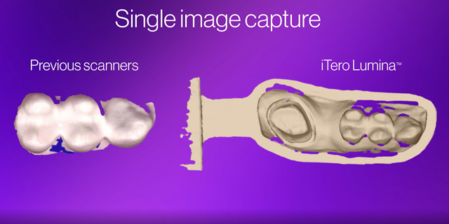 New Align iTero Lumina IOS