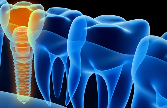 Waterpik: Maintaining Implants