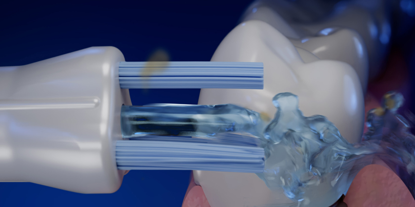 Waterpik: Maintaining Implants